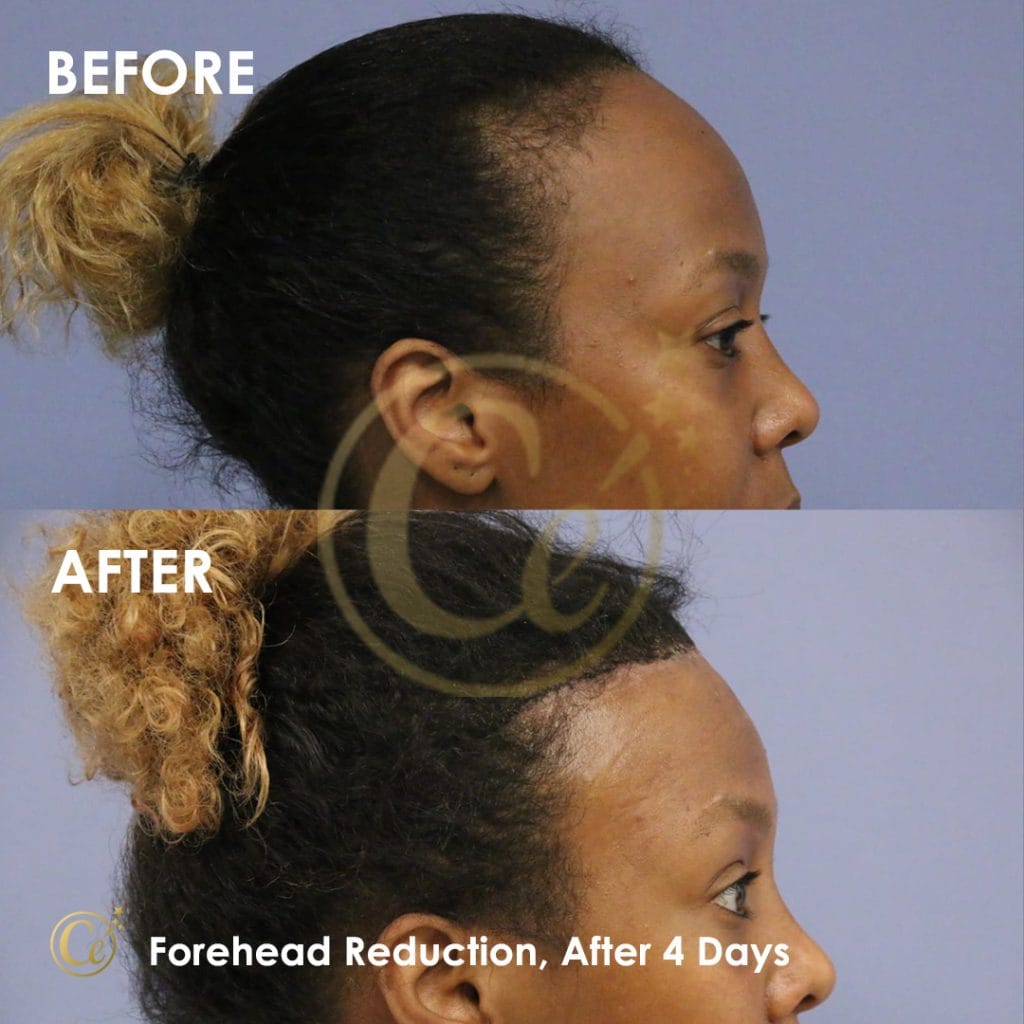 Forehead Reduction - Dr. Cengizhan Ekizceli