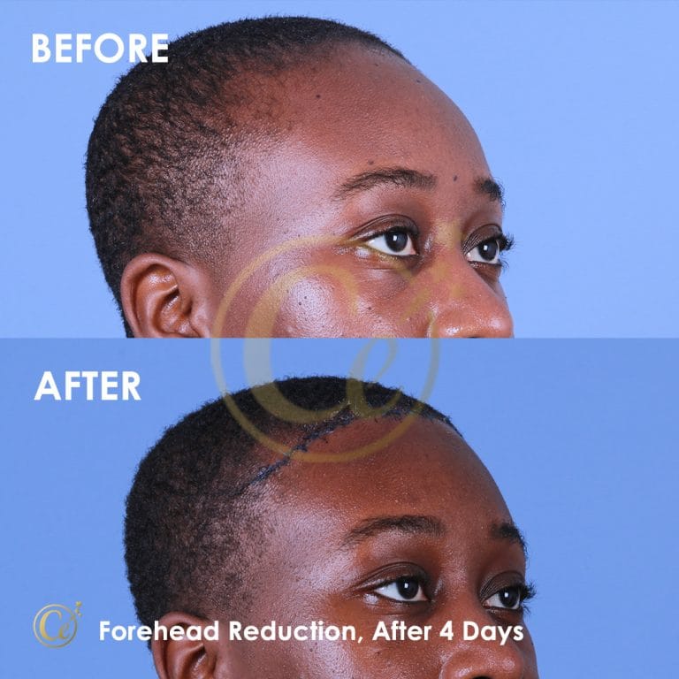 Forehead Reduction - Dr. Cengizhan Ekizceli