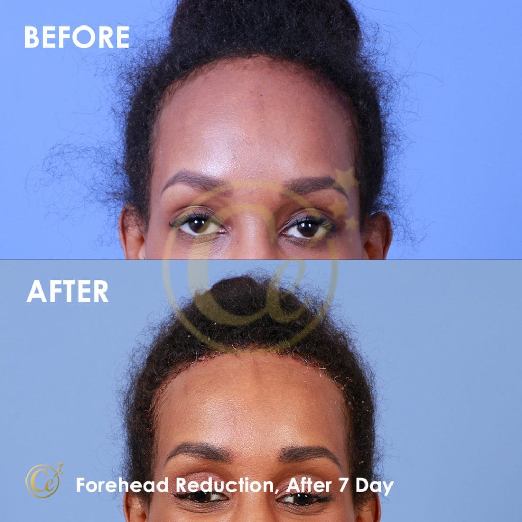 Forehead Reduction - Dr. Cengizhan Ekizceli