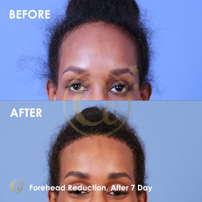 Forehead Reduction Surgery in Turkey - Dr. Cengizhan Ekizceli
