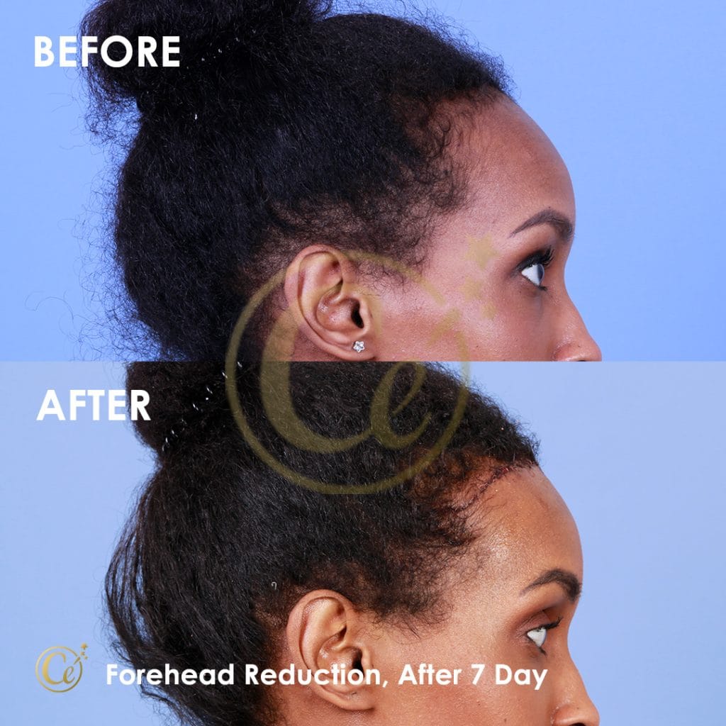 Forehead Reduction - Dr. Cengizhan Ekizceli