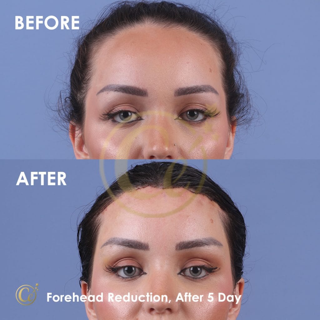 Forehead Reduction - Dr. Cengizhan Ekizceli