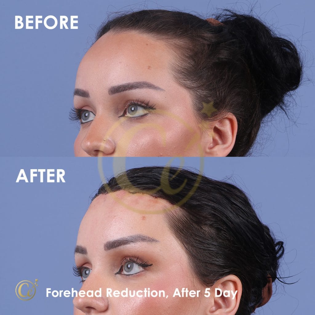 Forehead Reduction - Dr. Cengizhan Ekizceli