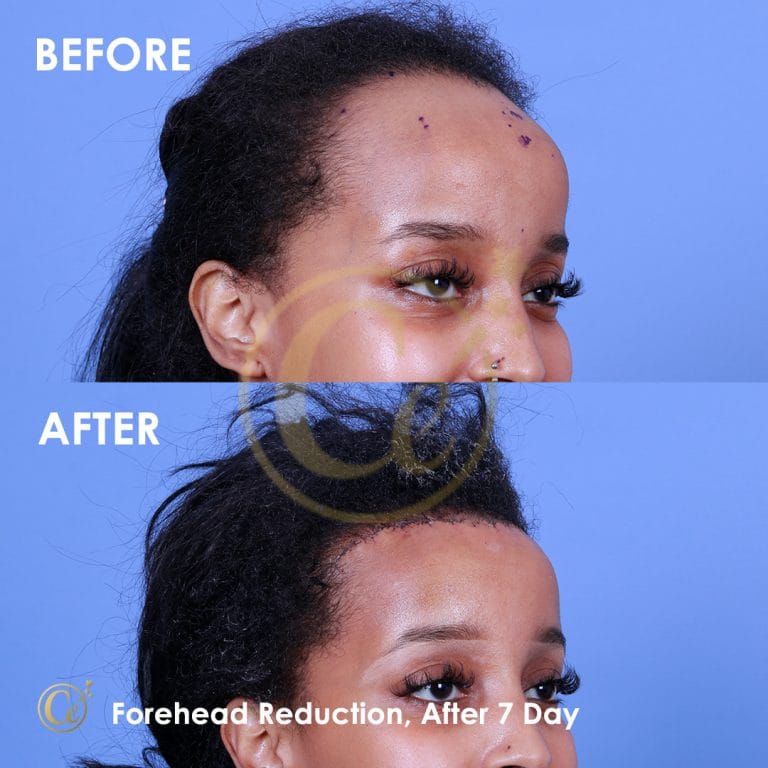 Forehead Reduction - Dr. Cengizhan Ekizceli