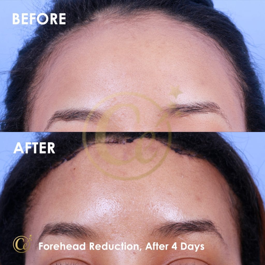Forehead Reduction Surgery Before and After - Dr. Cengizhan Ekizceli