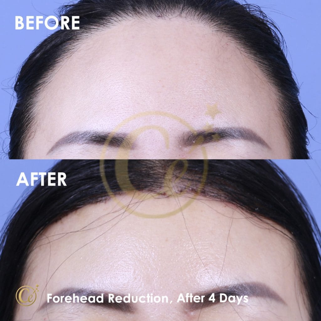 Forehead Reduction Surgery Before and After - Dr. Cengizhan Ekizceli