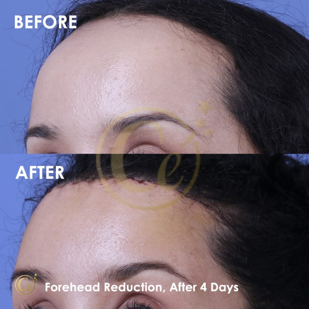 Forehead Reduction Surgery Before and After - Dr. Cengizhan Ekizceli