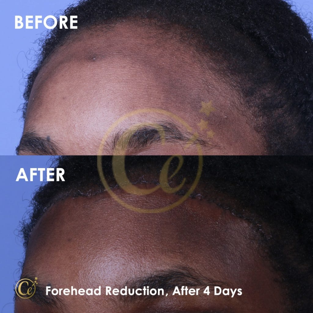 Forehead Reduction Surgery Before and After - Dr. Cengizhan Ekizceli