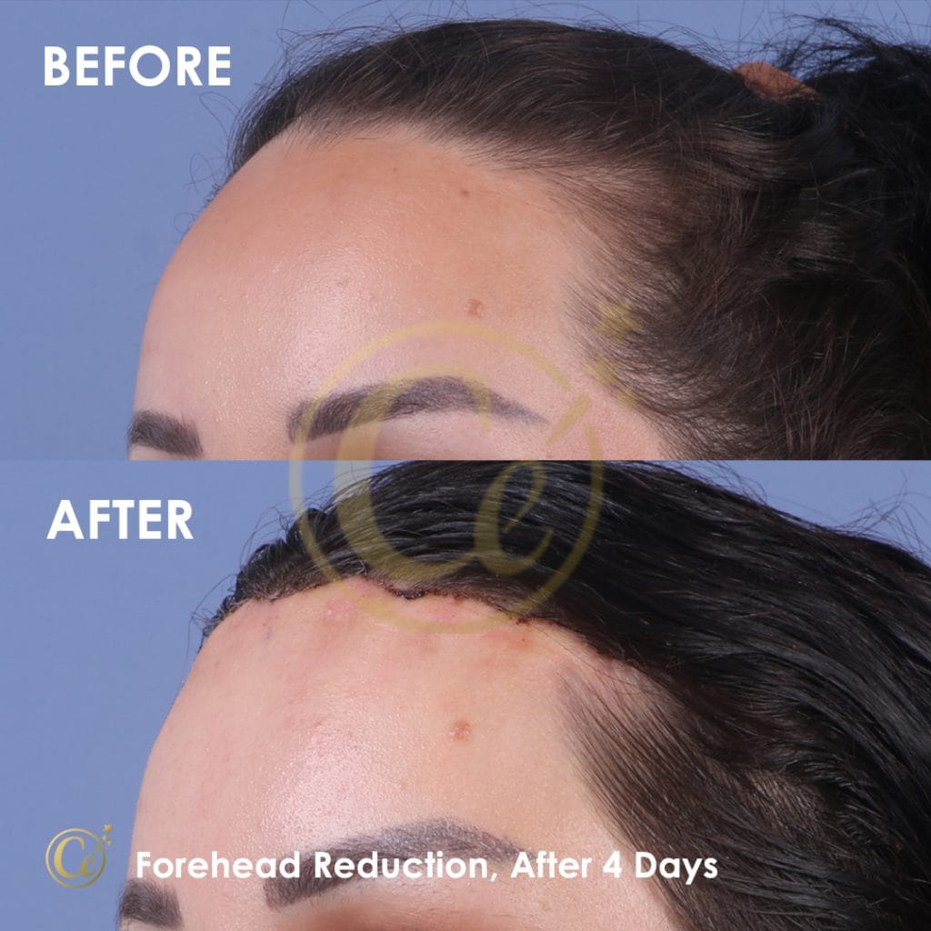 Forehead Reduction Surgery Before and After - Dr. Cengizhan Ekizceli