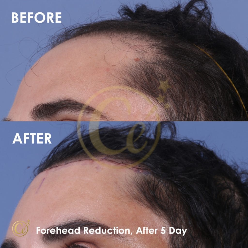 Forehead Reduction Surgery Before and After - Dr. Cengizhan Ekizceli