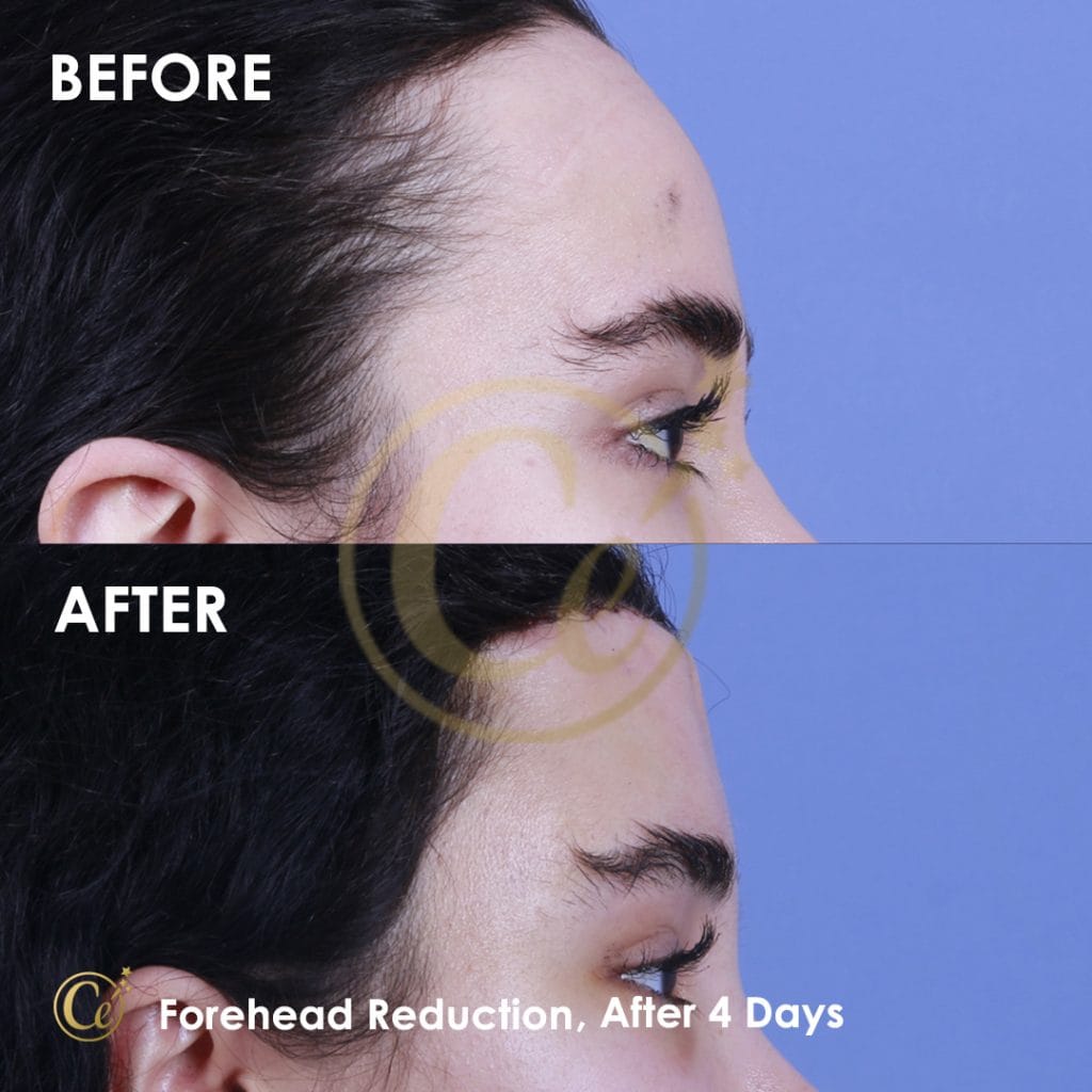 Forehead Reduction - Dr. Cengizhan Ekizceli