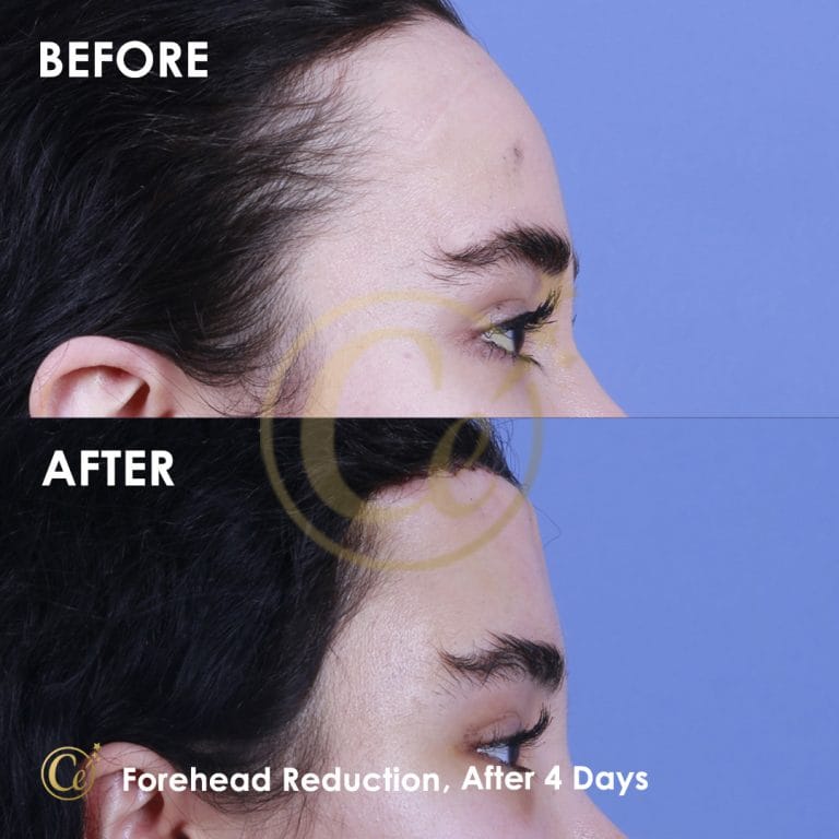 Forehead Reduction Surgery in Turkey - Dr. Cengizhan Ekizceli