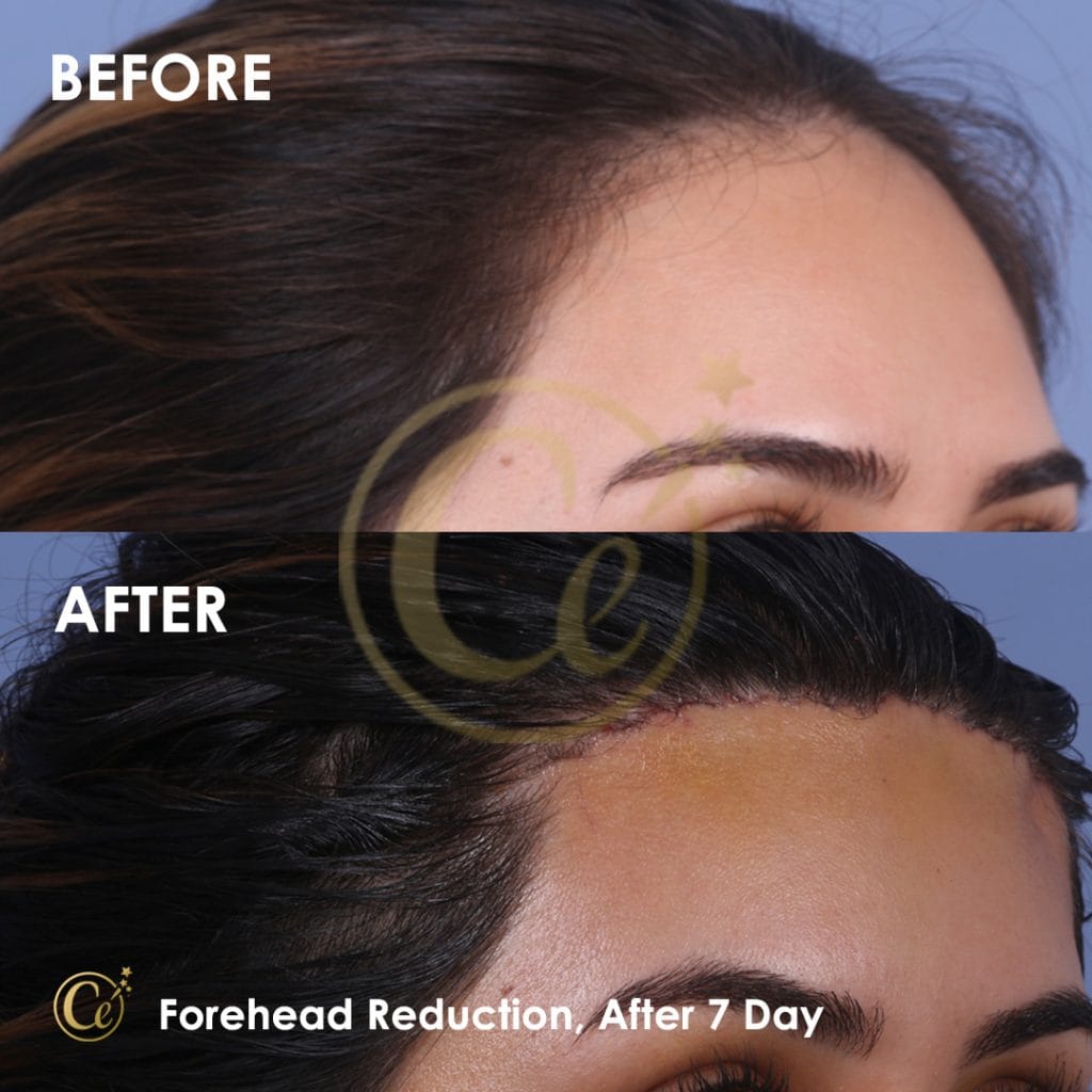 Forehead Reduction Surgery Before and After - Dr. Cengizhan Ekizceli