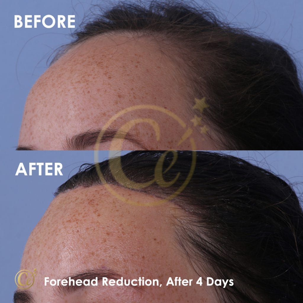Forehead Reduction Surgery Before and After - Dr. Cengizhan Ekizceli