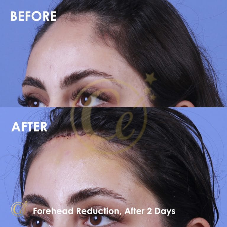 Forehead Reduction Surgery Before and After - Dr. Cengizhan Ekizceli