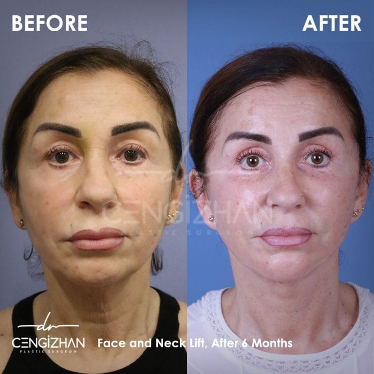 Facelift in Turkey Results - Dr. Cengizhan Ekizceli