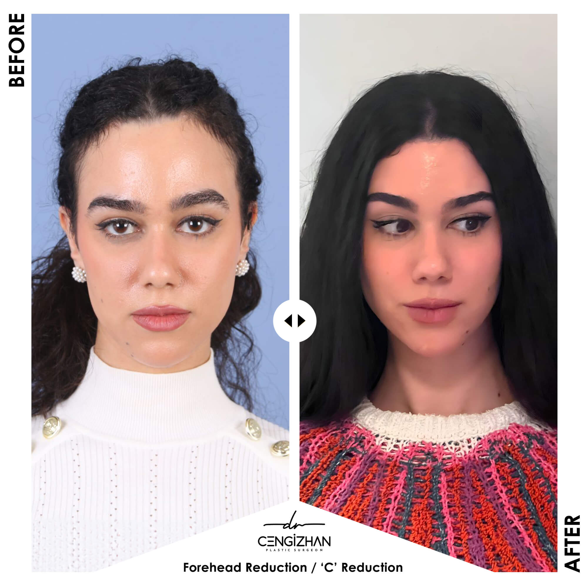 Forehead Reduction vs. Hair Transplant - Dr. Cengizhan Ekizceli