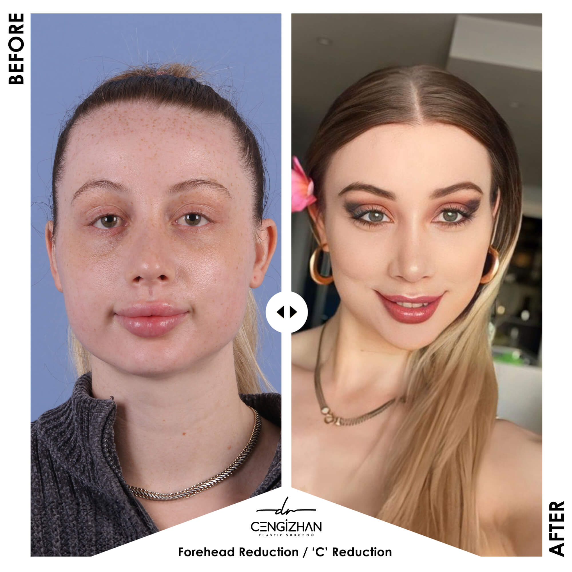 Forehead Reduction vs. Hair Transplant - Dr. Cengizhan Ekizceli