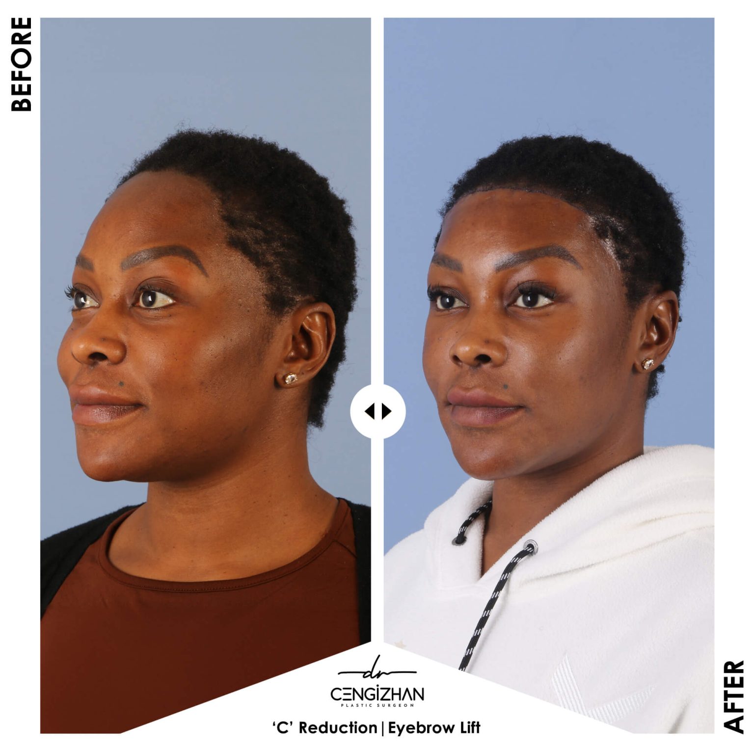 Forehead Reduction vs. Hair Transplant - Dr. Cengizhan Ekizceli