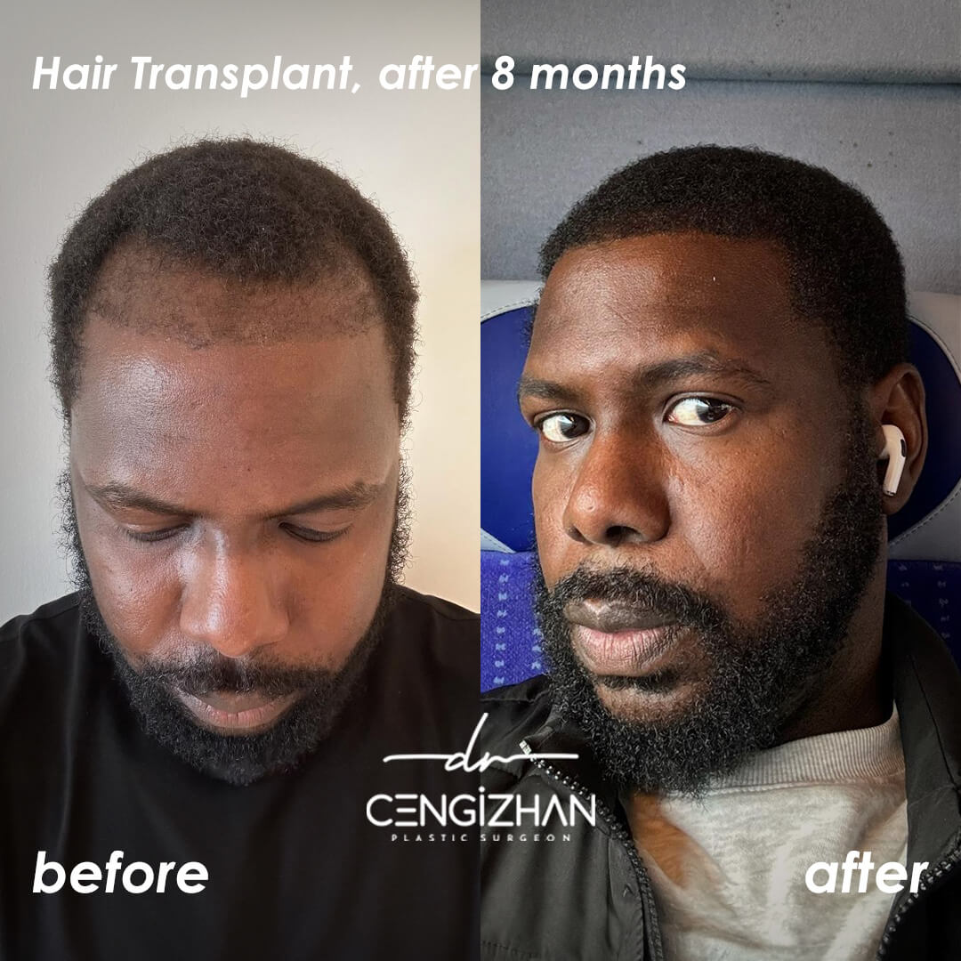 Forehead Reduction vs. Hair Transplant - Dr. Cengizhan Ekizceli