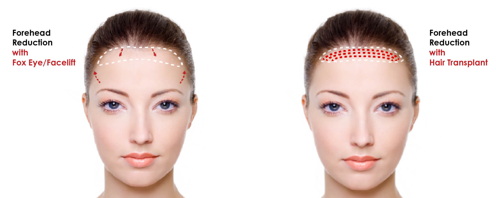 Forehead Reduction vs. Hair Transplant - Dr. Cengizhan Ekizceli