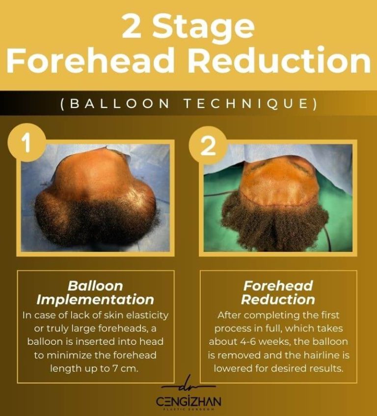 2 Staged Forehead Reduction: Balloon Technique - Dr. Cengizhan Ekizceli