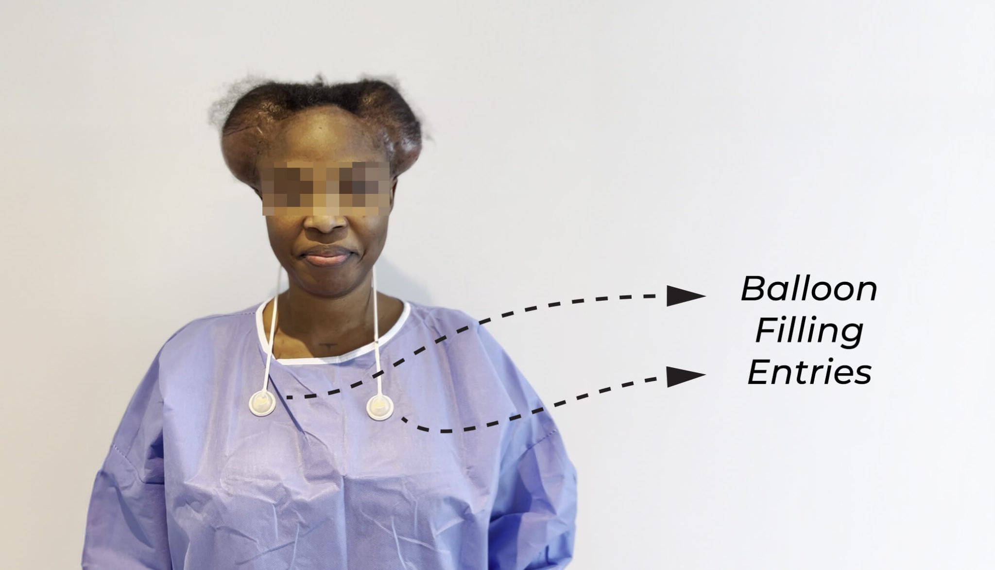 2 Staged Forehead Reduction: Balloon Technique - Dr. Cengizhan Ekizceli