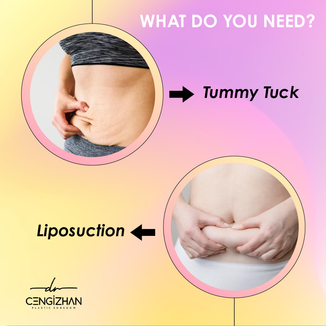 Tummy Tuck vs. Liposuction: Know the Difference - Dr. Cengizhan Ekizceli Tummy Tuck vs. Liposuction: Know the Difference - Dr. Cengizhan Ekizceli